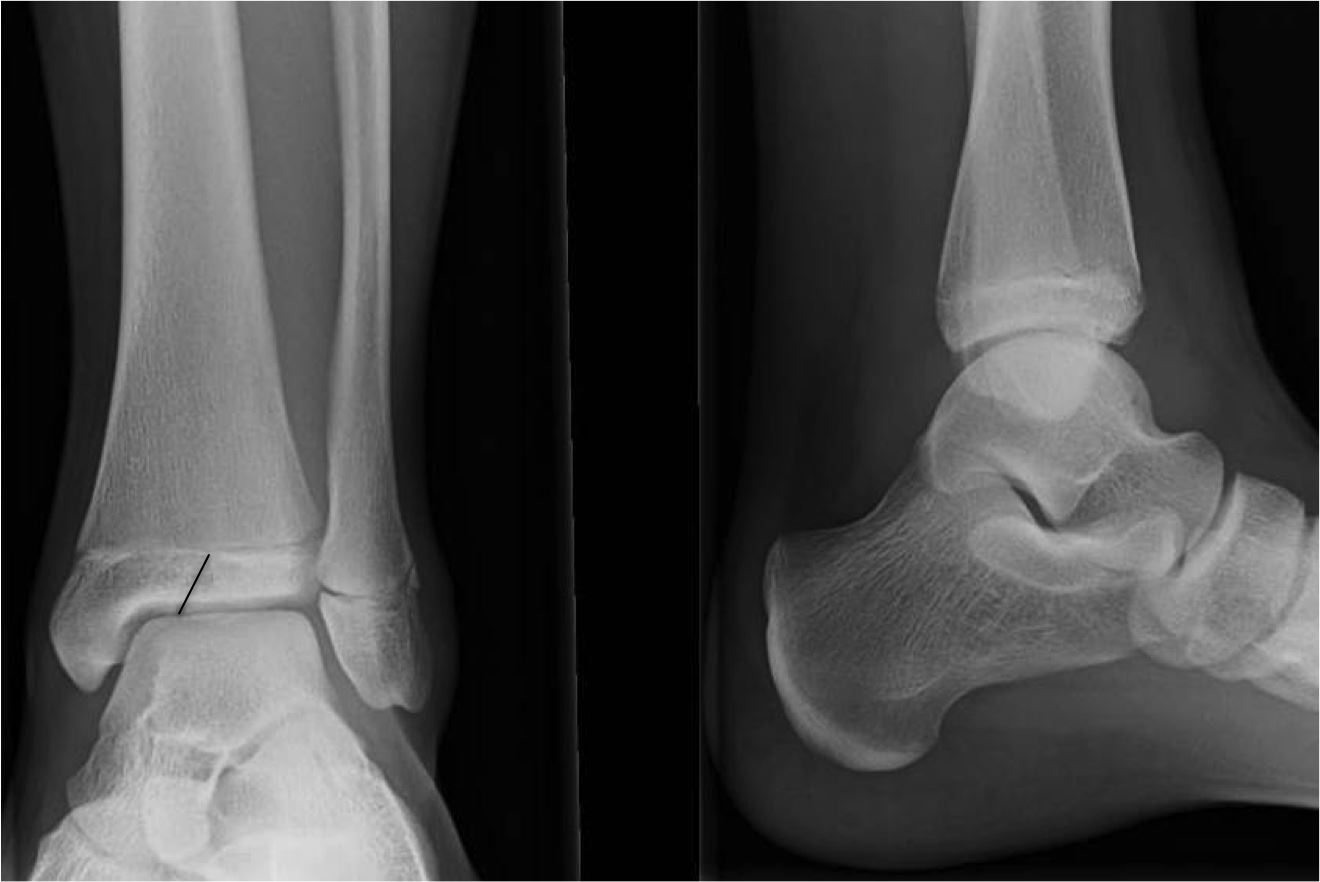 Salter Harris Tibial Fracture Salter Harris Tibial Fracture